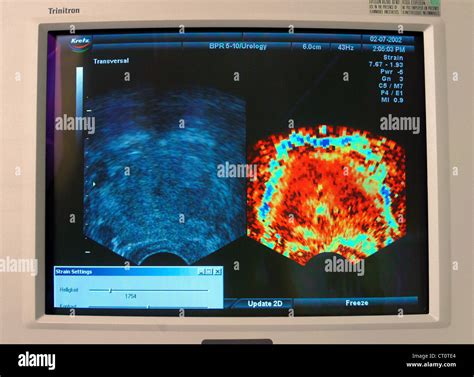 Prostate Cancer Screening Stock Photo Alamy