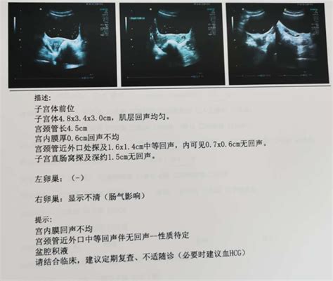 妇检发现阴道后穹窿破裂口深达肌层！患者却说没有诱因？ 丁香园
