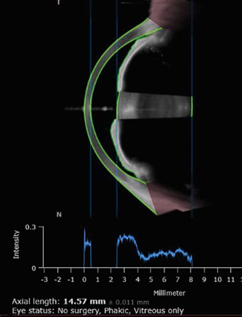 Escrs Advancing Biometry