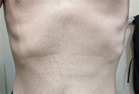 Why Is My Rib Cage Uneven Ranatomy