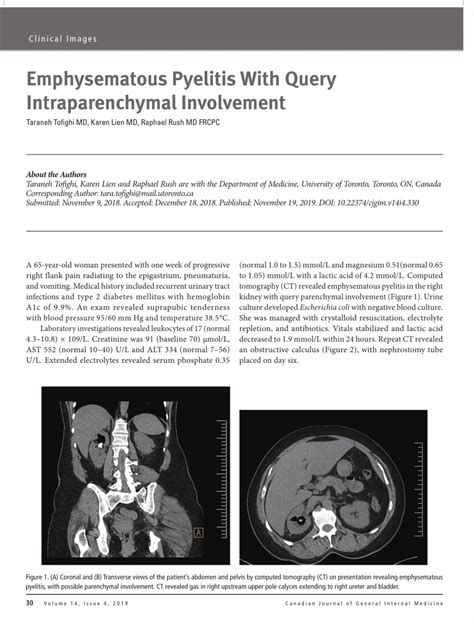 Pdf Emphysematous Pyelitis With Query Intraparenchymal Involvement Clinical Images