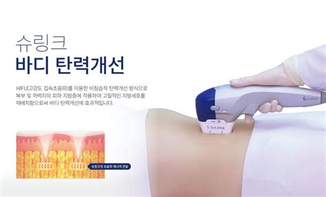Hifu고강도 집속초음파 비침습적 슈링크