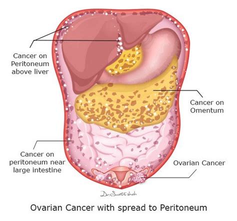 Know About Peritoneal Cancers From Hipec Treatment Doctor In Ahmedabad Cancerclinix