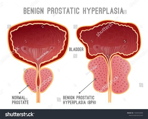 Benign Prostatic Hyperplasia