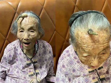 中 107세 할머니 “이마 ‘뿔 정체 뭘까”… 의사 진단 뭔지 봤더니 당신의 건강가이드 헬스조선