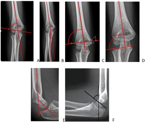 Supplemental Materials For Pediatric Elbow Measurement Parameters