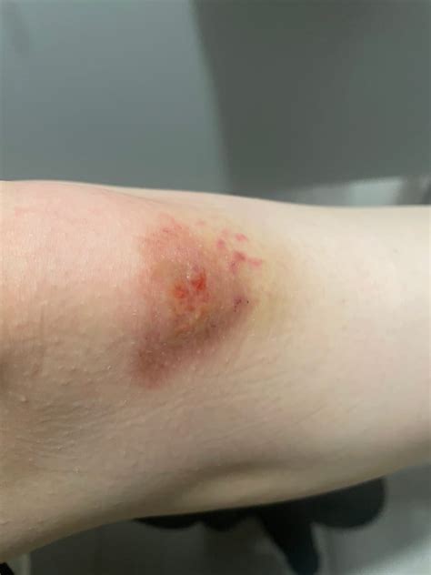 무릎 상처 지식in