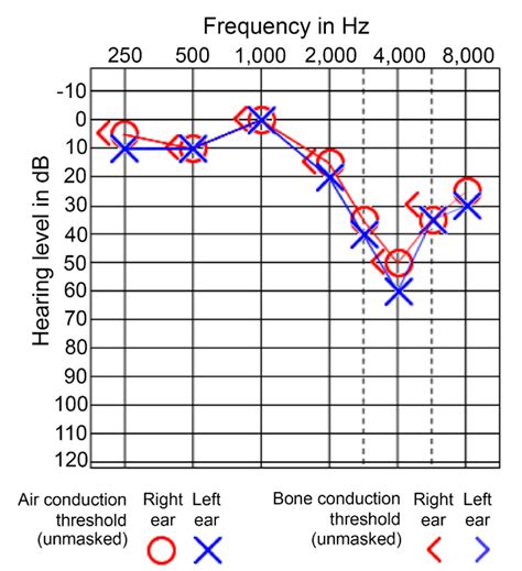 Jcm Free Full Text Noise Induced Hearing Loss