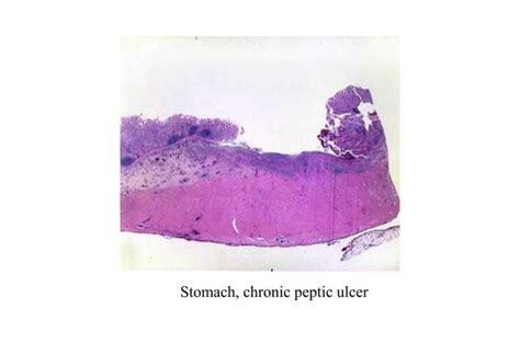 Final Peptic Ulcer Pptx