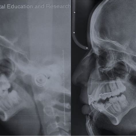 Lateral Cephalogram Showing Improvement In Posterior Airway Space