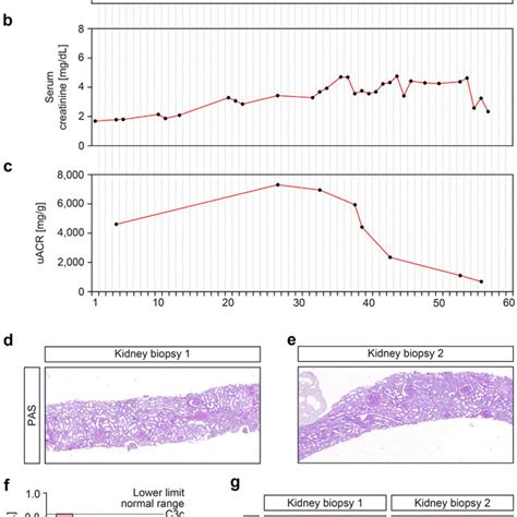 Pdf Tailored Use Of Avacopan In A Case With Refractory Anca