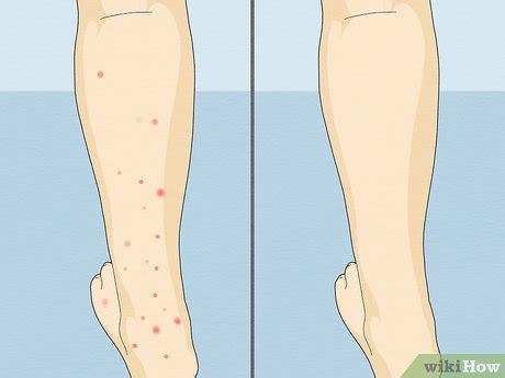 How To Treat No See Um Bites Home Treatment For Quick Relief