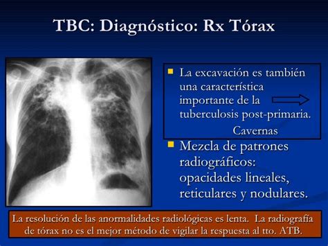 Tuberculosis Clase 1
