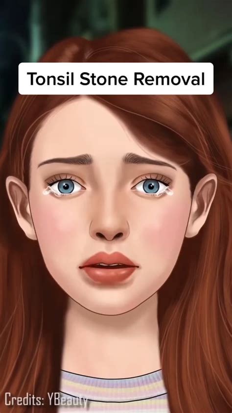 62tonsil Stone Removal Animation Asmr Satisfying Transformation