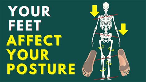 Flat Feet Bad Posture At Eileen Porras Blog