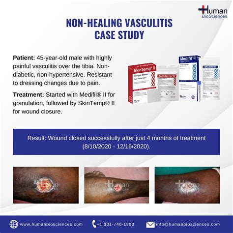 Human Biosciences Inc Usa On Linkedin Non Healing Vasculitis Success