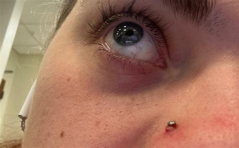 Piercing Granuloma R Piercing