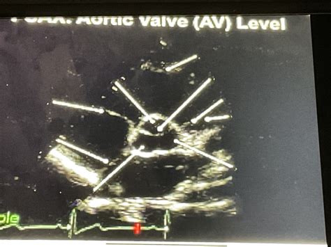 Psax Aortic Level Image 2 Diagram Quizlet