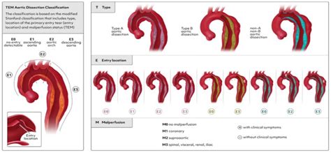 Update In Aortic Dissection Cimjournal