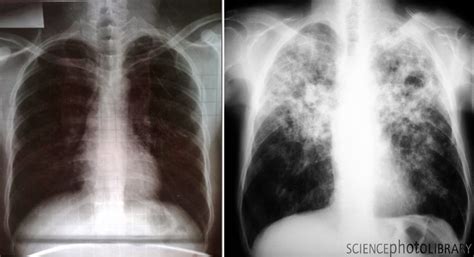 Materi Penyakit Pada Sistem Pernapasan Manusia ~ Rofa Education Centre