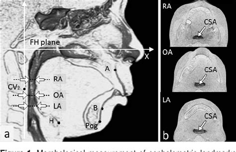 Figure 1 From Herbst Appliance Effects On Pharyngeal Airway Ventilation Evaluated Using