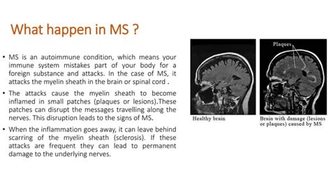 Multiple Sclerosis Pathophysiology Diagnosis And Treatment Pptx