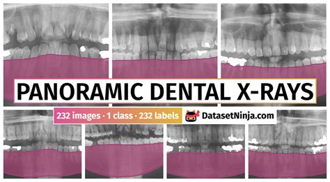 Panoramic Dental X Rays Dataset Ninja