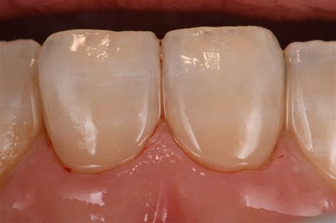 Cervical Abrasion Can Be Aggravated By Erosion