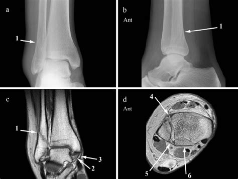 Boot For Distal Fibula Fracture At Timothy Bottom Blog