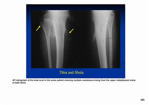 Multiple Hereditary Exostosis An Atlas Of Musculoskeletal Oncology