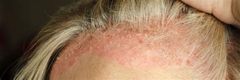Metagenomic Alterations In Scalp Psoriasis And Antimicrobial Resistance