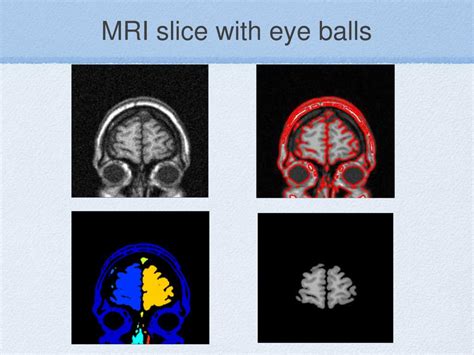 Ppt Mri Brain Extraction Using A Graph Cut Based Active Contour Model Powerpoint Presentation