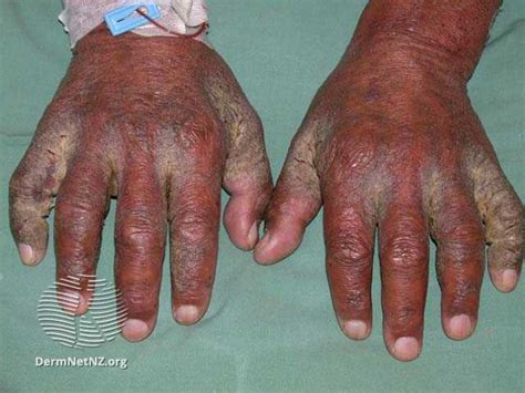 Dermnet Scabies Scabies