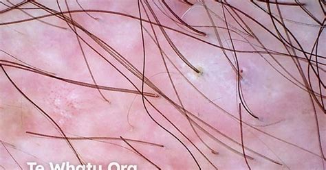 Folliculitis Keloidalis Image