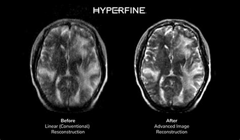 The Swoop® Portable Mr Imaging® System