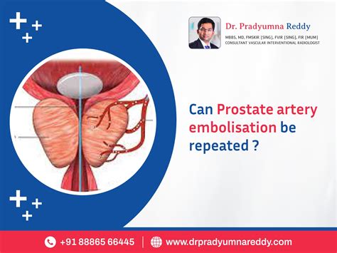 Can Prostate Artery Embolization Be Repeated Dr Pradyumna Reddy