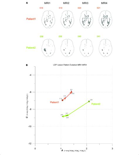 A Axial Projections Of Evolving Ms Wml Patterns Of Two Patients