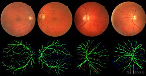 Tensorflow2实现unet 完成眼底血管分割任务 Qq61726c6324c0f的技术博客 51cto博客