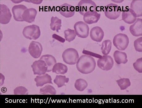 Lab Atlas Hemoglobin C Crystals