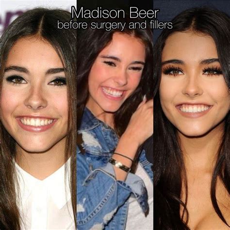 Madison Beer Plastic Surgery And Fillers Plastic Surgery Madison