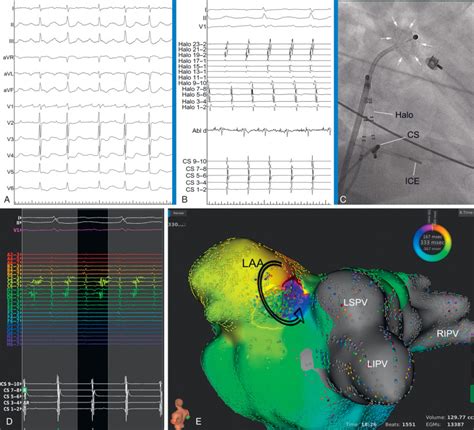 Macroreentrant Atrial Tachycardia Thoracic Key