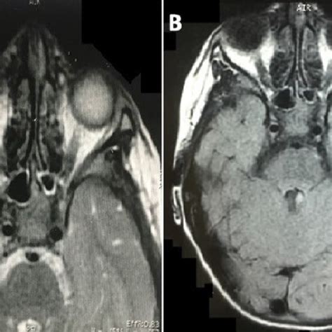 Postoperative Brain And Orbital Mri Axial T2 Weighted Sequence A And Download Scientific