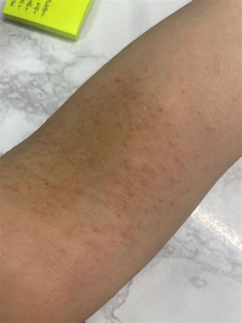 왼쪽 팔 접히는 부분만 자꾸 간지럽고 사진과같아요 어떻게 간지러움을 없앨까요 ㅣ 궁금할 땐 아하