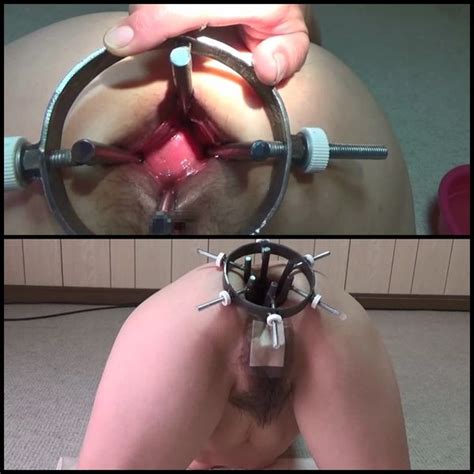 Forumophilia PORN FORUM Extreme Anal Dilation And Anal Pussy Fisting Exclusive Page