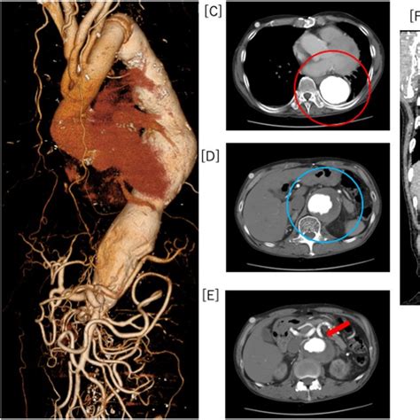 Schematic Representation Of Taaa Repair A Skin Incision Stoney