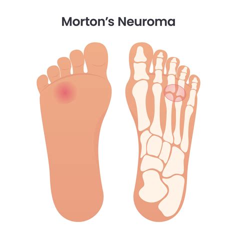 Mortons Neuroma Jacksonville Fl Chiropractor Silver Chiropractic