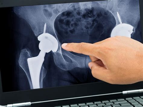 New Year New Hip All You Need To Know About Hip Replacement Alpha