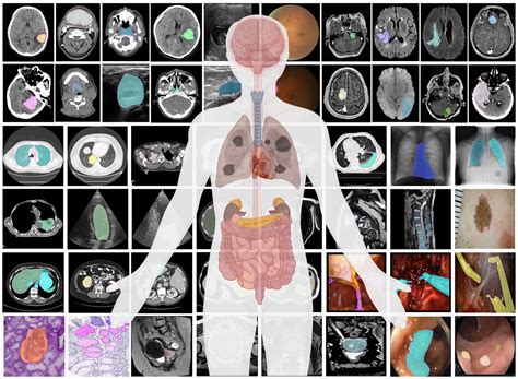Adapt Segment Anything For Medical Image Segmentation By Juneta Tao