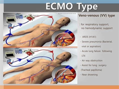 Ppt Ecmo U Nderstanding And Management Powerpoint Presentation Id 6589326