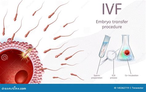 In Vitro Fertilization Embryo Transfer Procedure Stock Vector